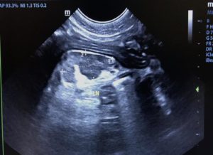 Ultrasound-Guided Lymph Node Culture - SonoPath