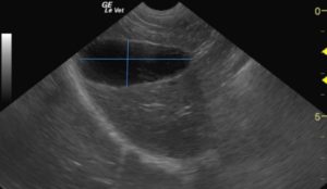 Gallbladder Motility Study - SonoPath