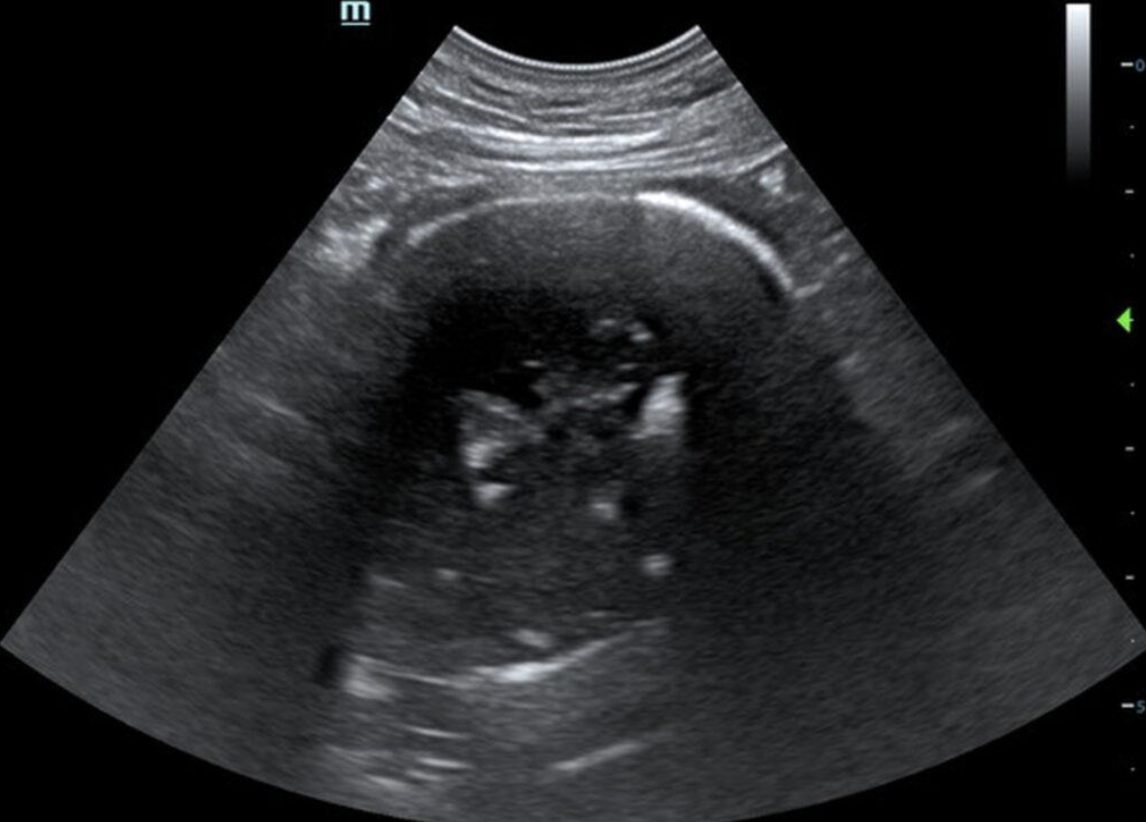 May Case of the Month - SonoPath