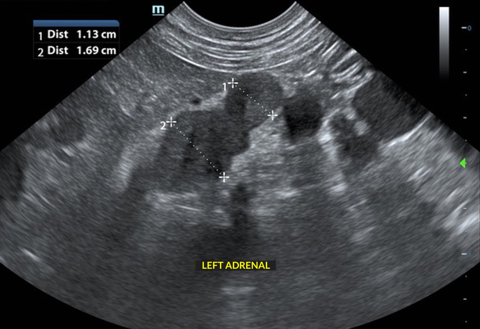 Left Adrenal Mass With Caval Invasion: Our Case Of the Month February ...