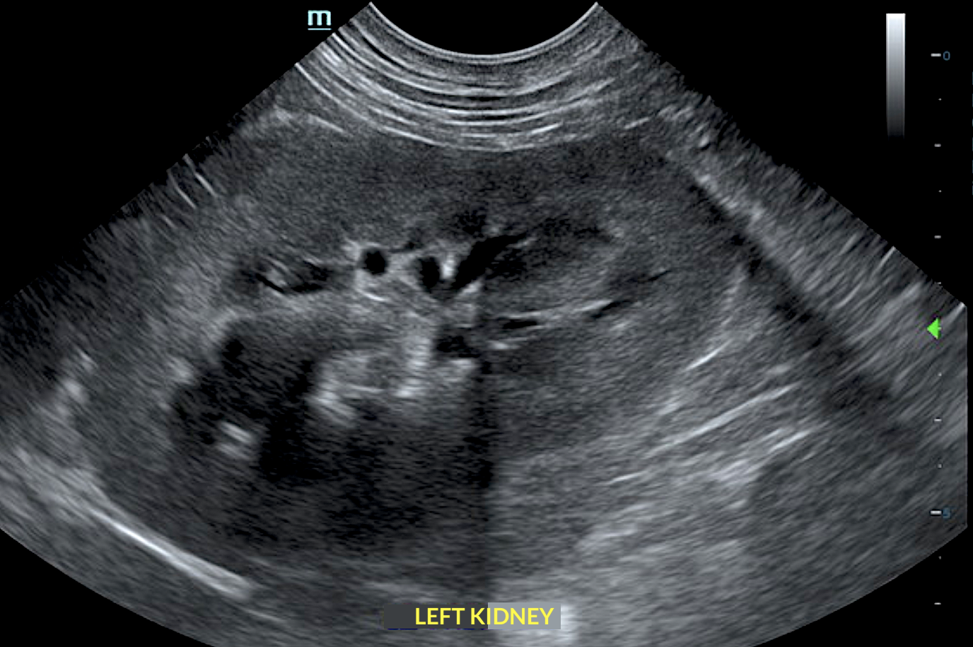 Left Adrenal Mass With Caval Invasion: Our Case Of the Month February ...