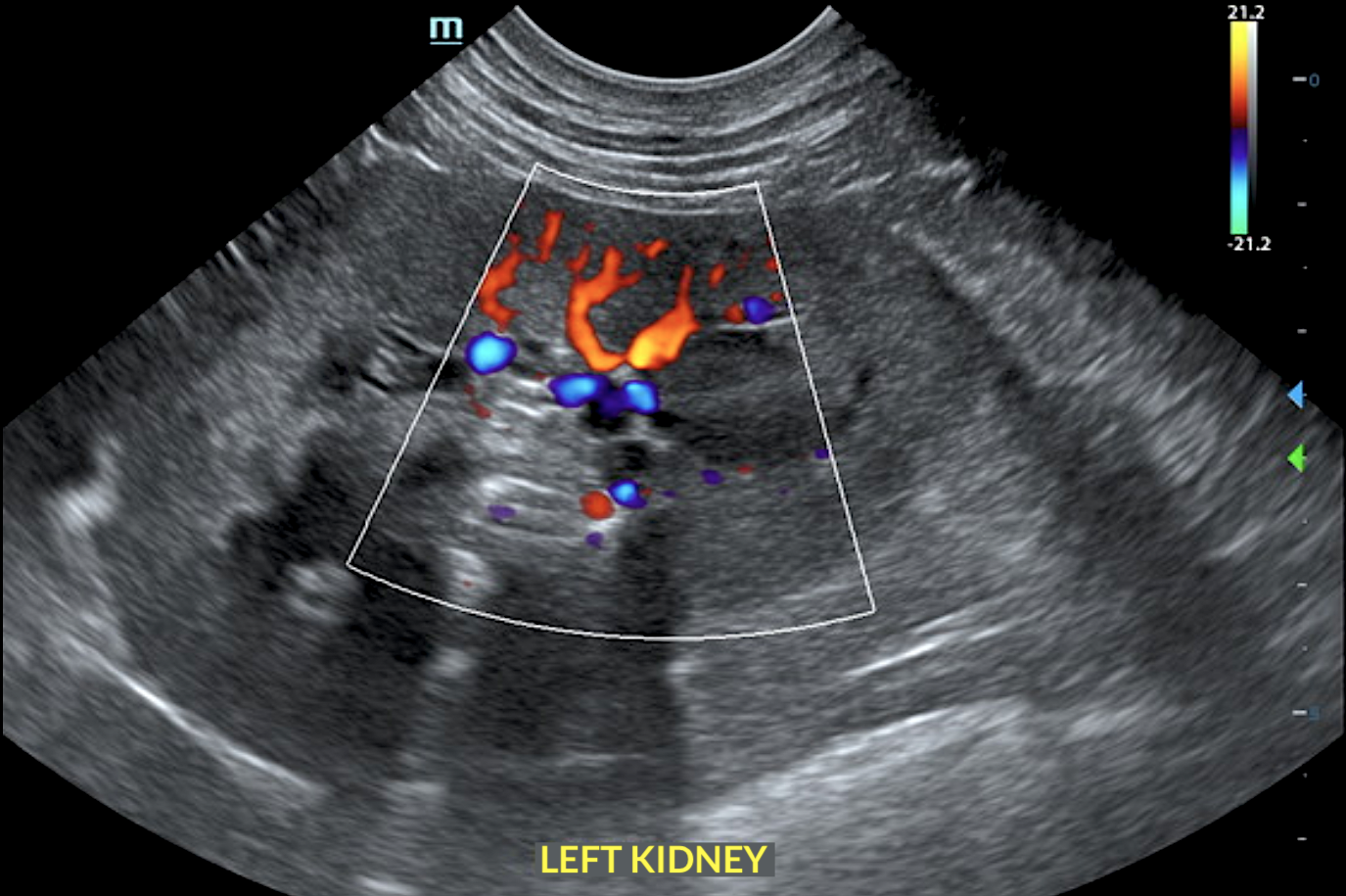 Left Adrenal Mass With Caval Invasion: Our Case Of the Month February ...