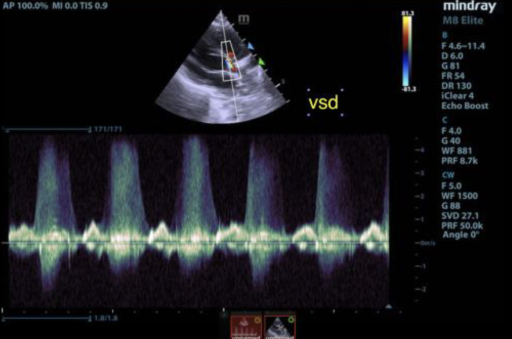 Ventricular Septal Defect: Our Case of the Month June 2024 - SonoPath